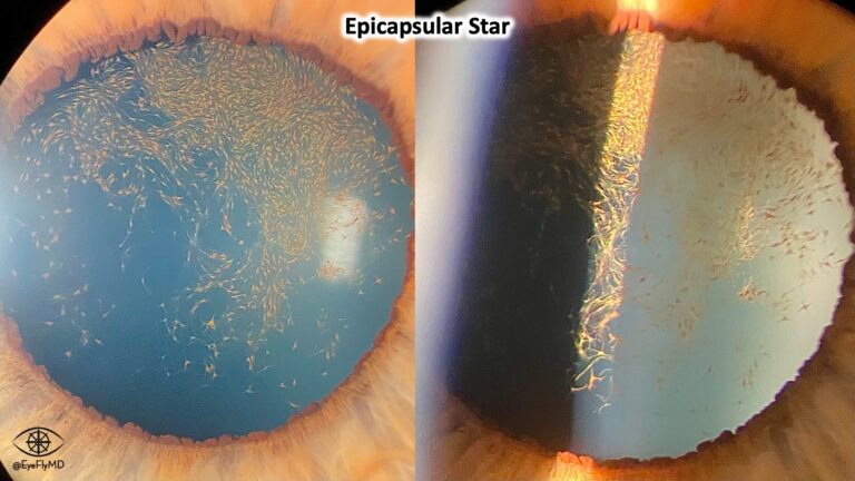 Interesting Cases and Pictures - Eye Fly MD