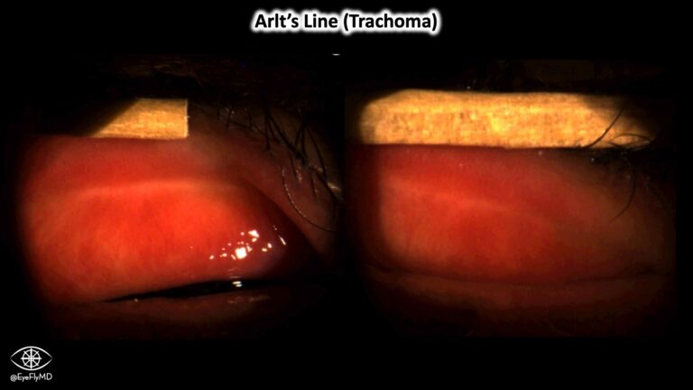 Interesting Cases and Pictures - Eye Fly MD